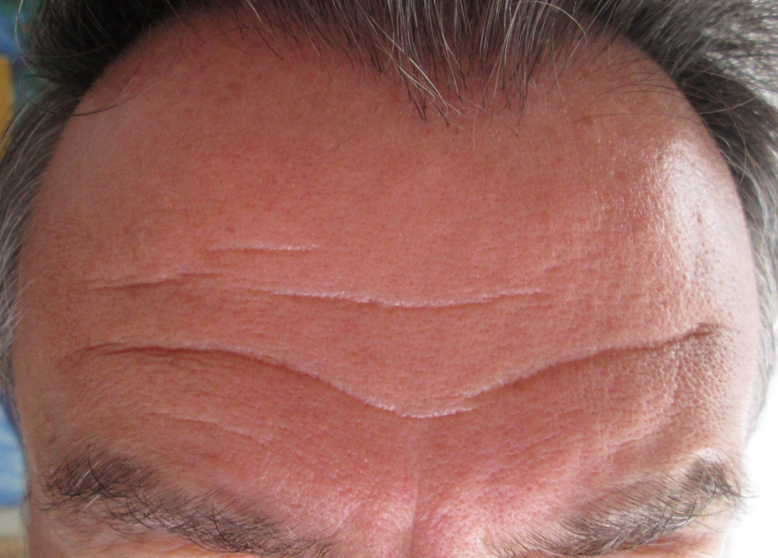 Botox - acido ialuronico | Lia Solomon